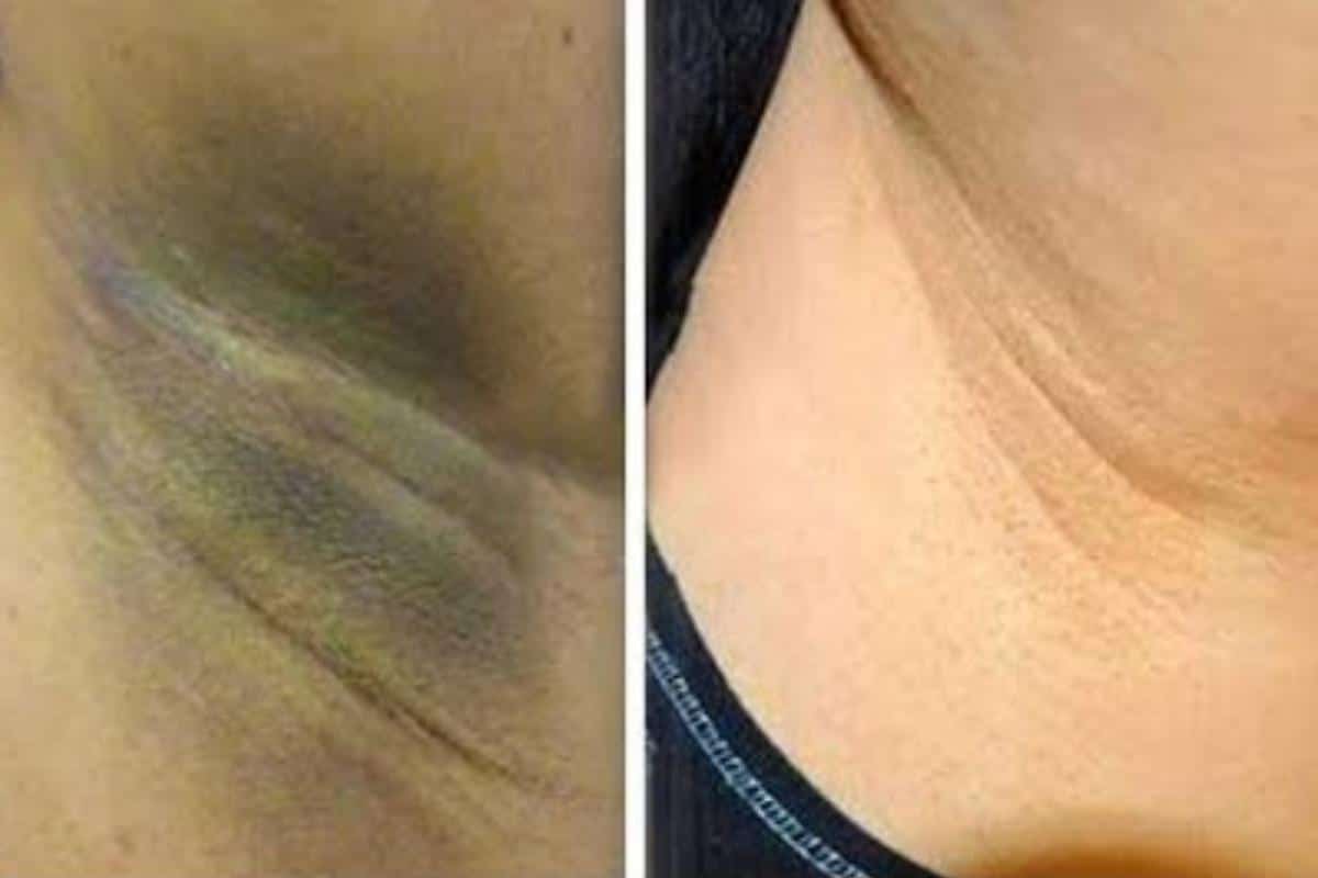 Como clarear as axilas com uma receita caseira que você vai amar o ...